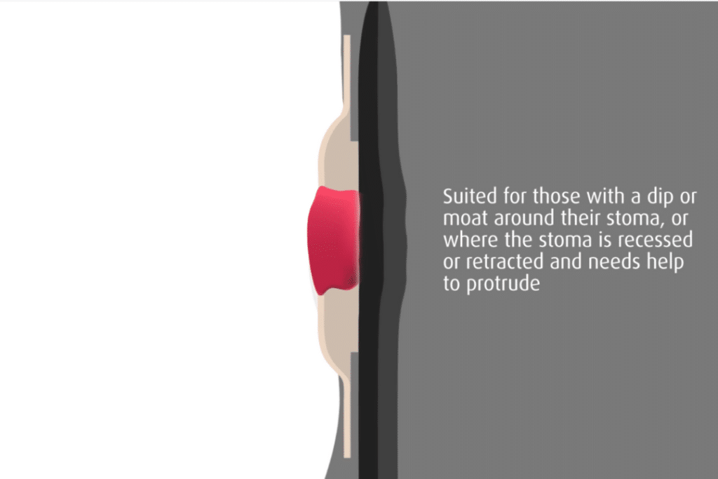 Colostomy Animation for Welland Medical! | Eon Visual Media